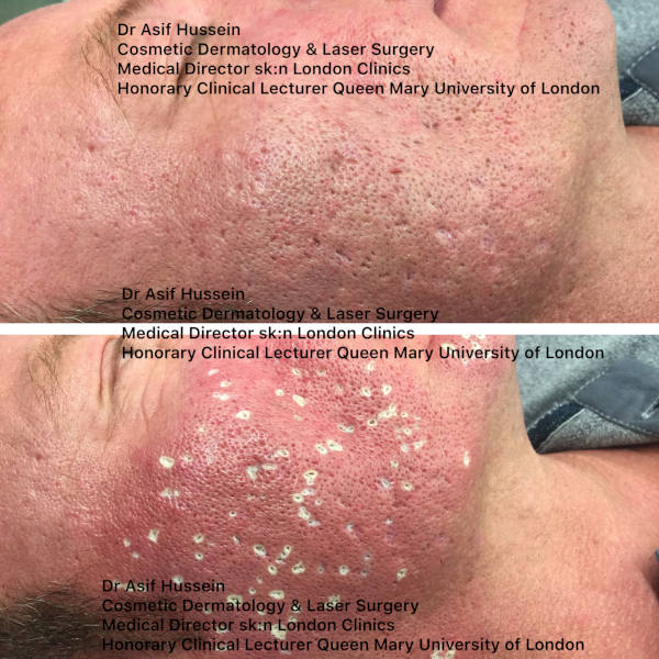 Acne Scar Laser Treatment Removal London Dr H Consult Acne Scar Laser Treatment Removal London Dr H Consult